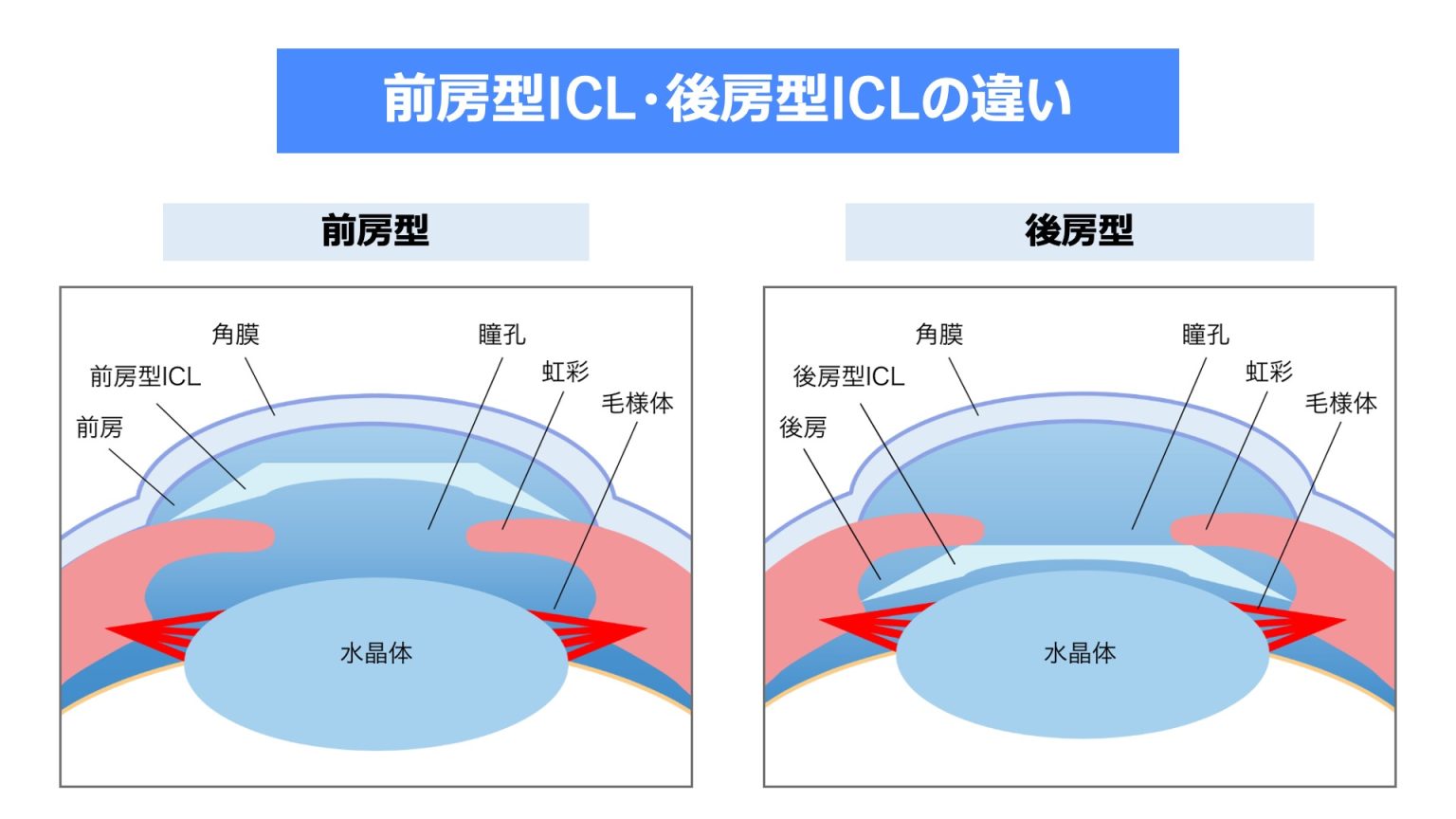 【2025年版】ICL手術の歴史を徹底解説｜技術の進化と安全性が高まるまで | リモートライフハック！